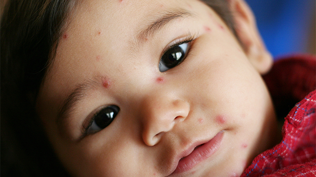 Siete datos que quizá no conocías sobre la varicela