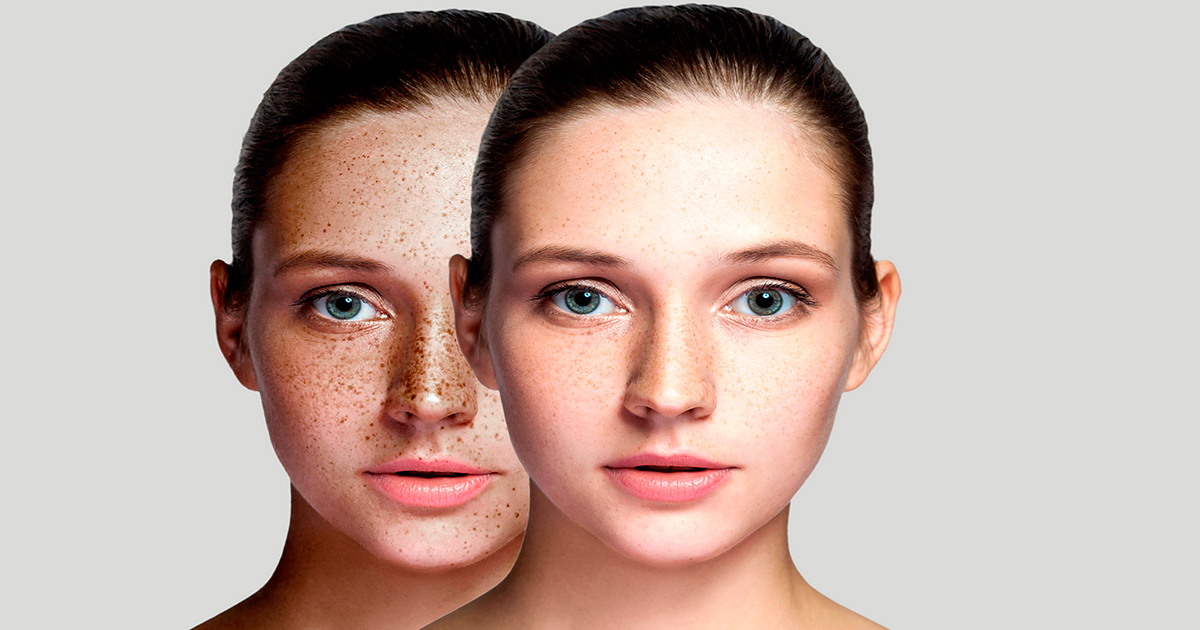 ¿Qué es el melasma y cómo solucionarlo?