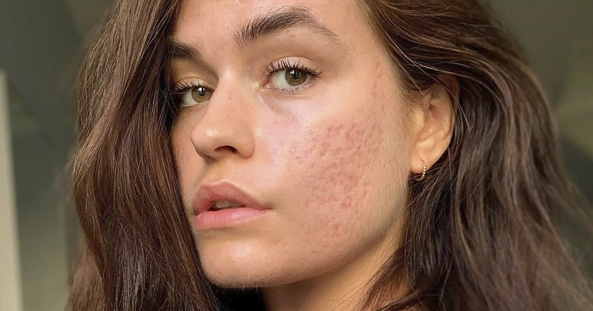 Mandamientos Para Aprender A Aceptar Tus Imperfecciones En La Piel