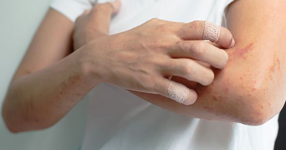 ¿Qué es la urticaria inducida por el ejercicio?