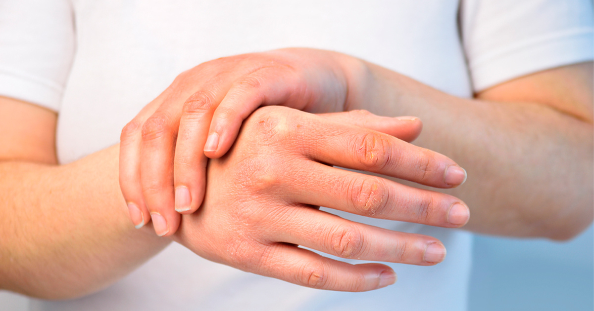 ¿Por qué se me pelan las manos y cómo prevenirlo?