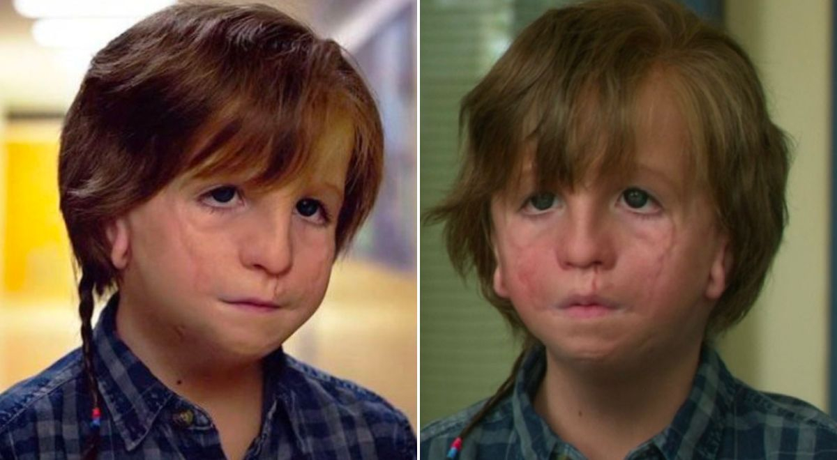 Así luce actualmente el niño abandonado por su rostro deforme: su ...