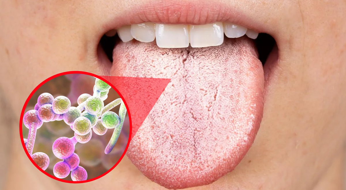 ¿Lengua blanca? Descubre qué significa y por qué podría ser una señal ...