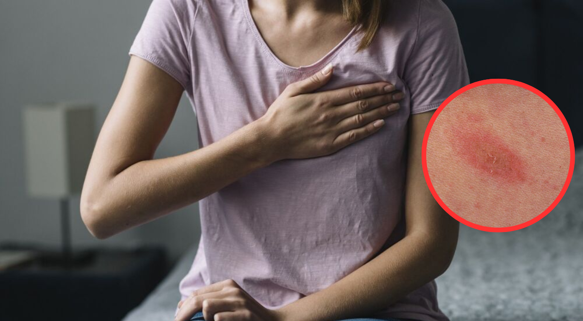 Manchas rojas en los senos: ¿una señal de alerta? Esto dicen los expertos
